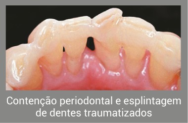 Interlig Fibra Vidro Trançada em Resina | Angelus