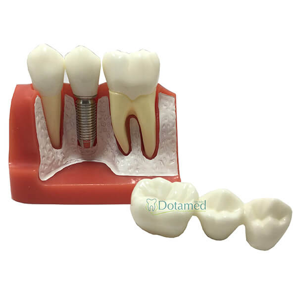 Modelo Anatómico Colocação Implante ArtMed - Dotamed Online