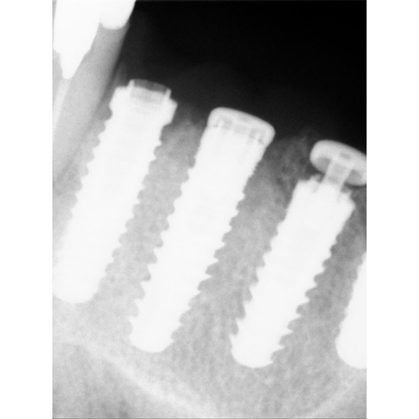 Sensor Intraoral RVG First - Trophy | Dotamed São João