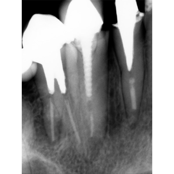 Sensor Intraoral RVG First - Trophy | Dotamed São João